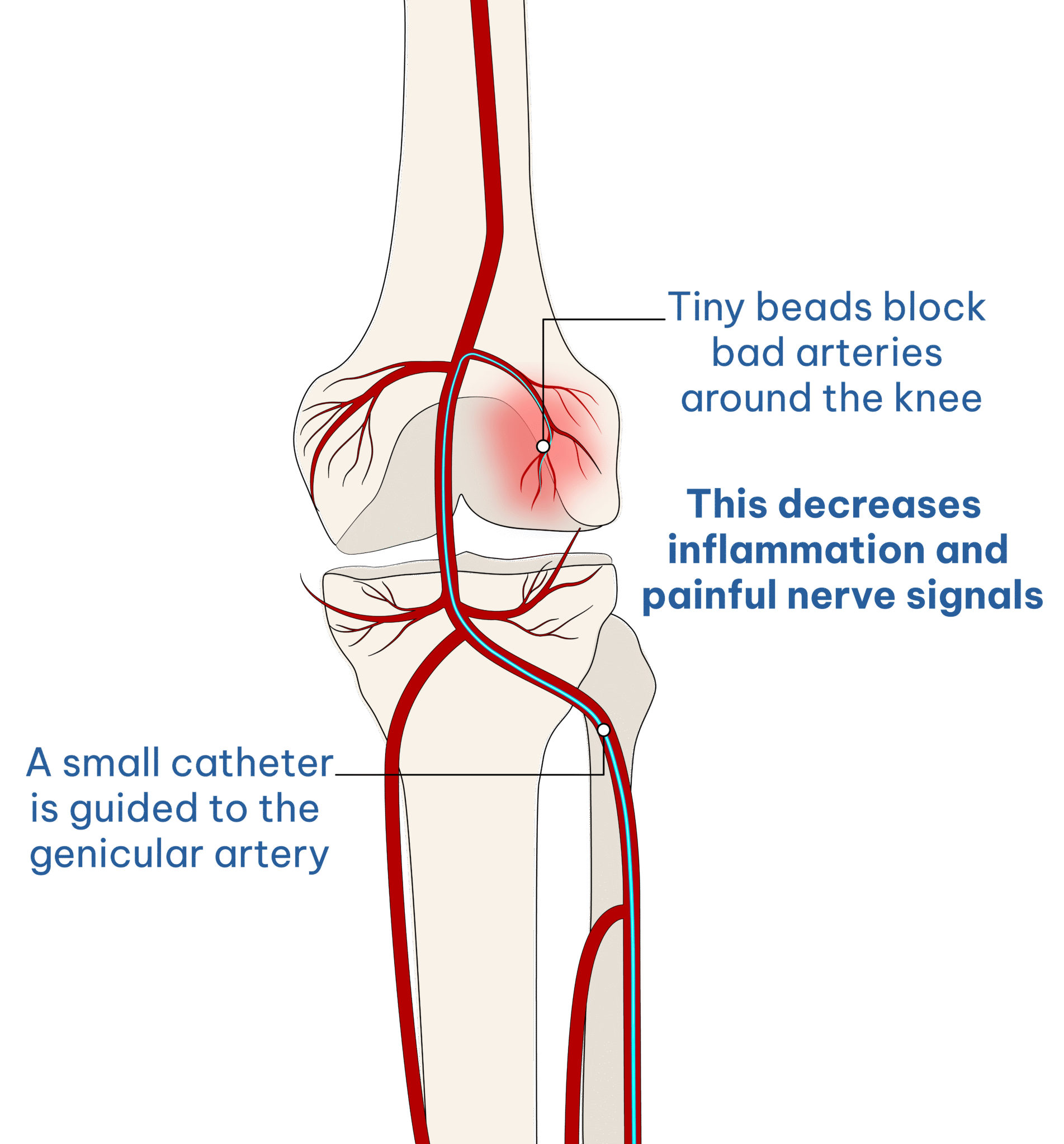 Genicular Artery Embolization (GAE) for Patients with Knee Pain ...